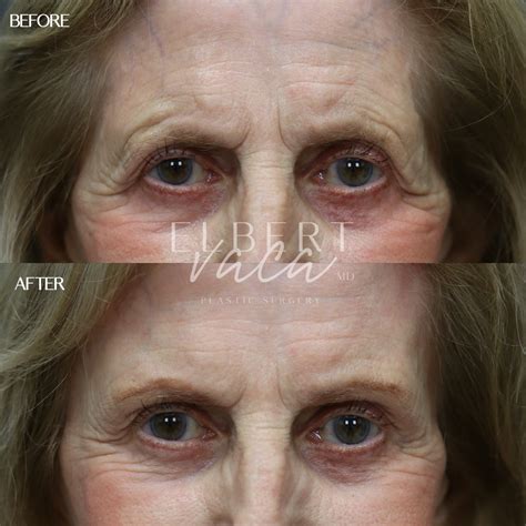 Browlift Gallery Elbert Vaca Dr Fagien And Dr Vaca Dr Fagien And Dr Vaca