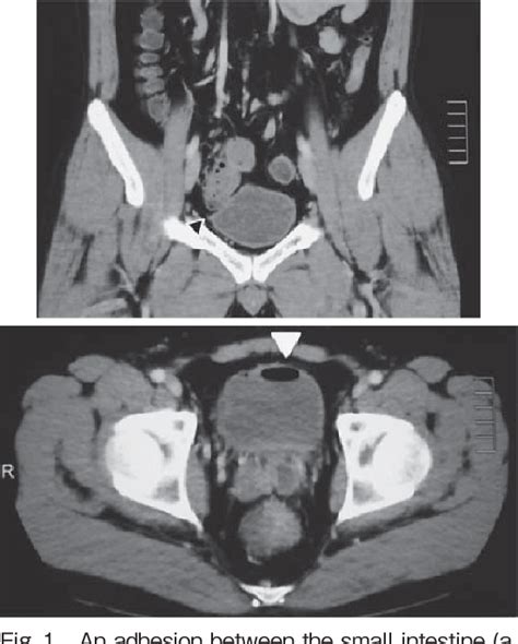 Structure Of Ostium Appendicis Vermiformis Semantic Scholar