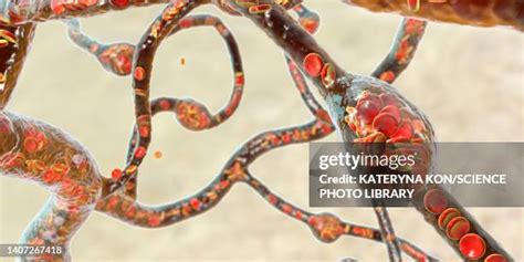 Ocular Pathology Photos And Premium High Res Pictures Getty Images