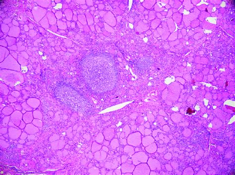 Thyroid Gland Total Thyroidectomy Showed Chronic Lymphocytic