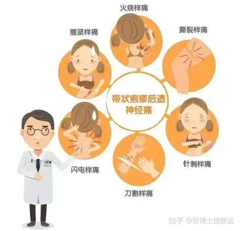 带状疱疹又上热搜，什么是带状疱疹？为什么很多人谈之色变？ 知乎