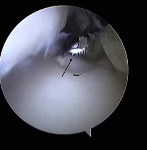 Bone Marrow Aspirate Concentrate And Microfracture Technique For Talar