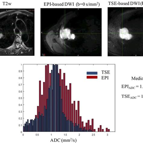 Example Of Epi‐ And Tse‐ Dwis Along With T2w Mri In Patient 2 All