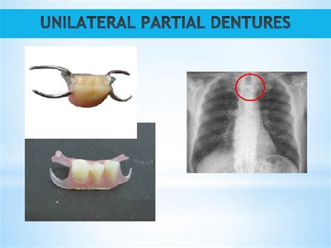 Guideplane Rpd Swinglock Rpd Removable Partial Overdenture Implant