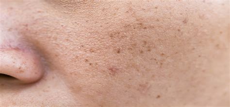 Understanding Pigmentation Vs Melasma The Complete Guide