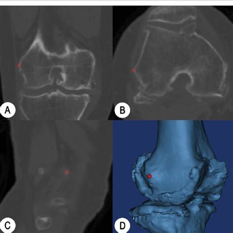 Abbreviations Tka Total Knee Arthroplasty Stea Surgical