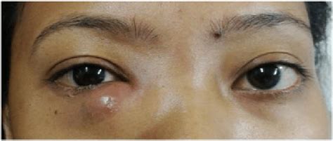 Right Lower Eyelid Abscess Download Scientific Diagram