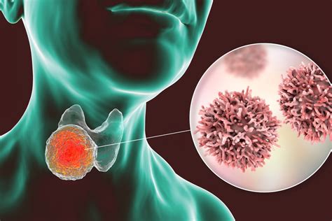Haigus Mille ülediagnoosimine Võib Viia Tõsiste Tervisekahjustusteni Maaleht