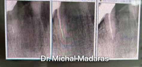 Michal Madaras On Linkedin Bypass Of Broken File