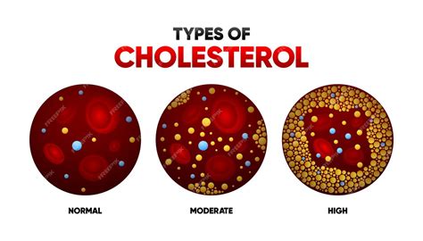 Premium Vector Types Cholesterol In Flat Style Ldl And Hdl Level