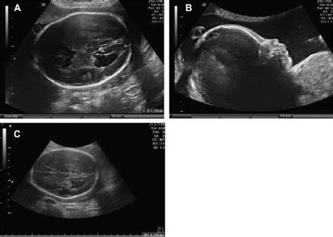 Macrocephaly Ultrasound Hydranencephaly Imaging Practice Essentials