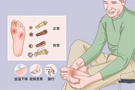 糖尿病患者一定会得糖尿病足？该如何预防？ 知乎