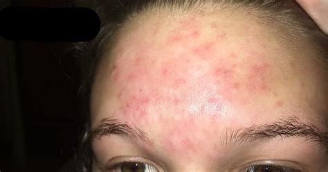 Skin Progress Album On Imgur