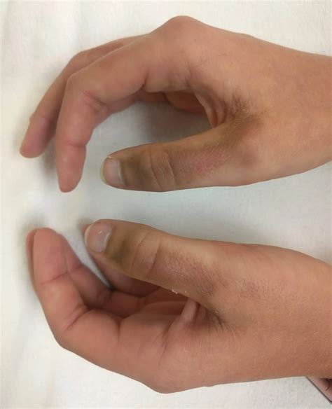 Photodermatitis Why There Is An Allergy To The Sun Healthy Food Near Me