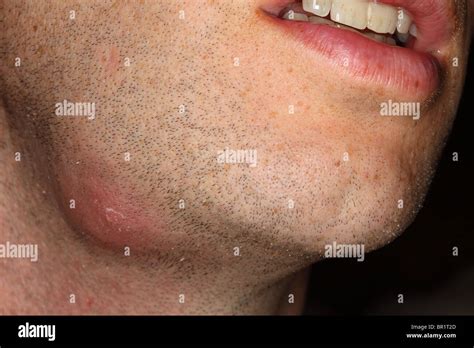 What Causes A Boil On Chin At Anna Pearce Blog