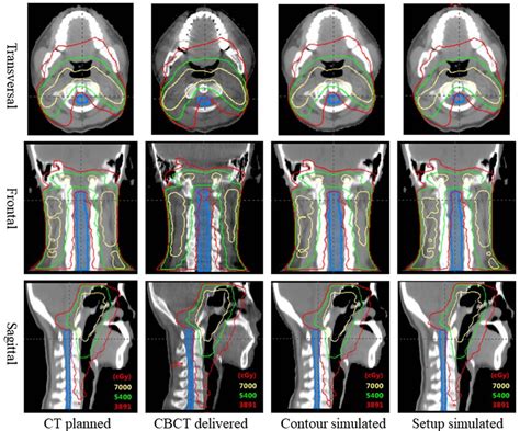 Dose Distribution Comparison Of Ct Planned Cbct Delivered And The