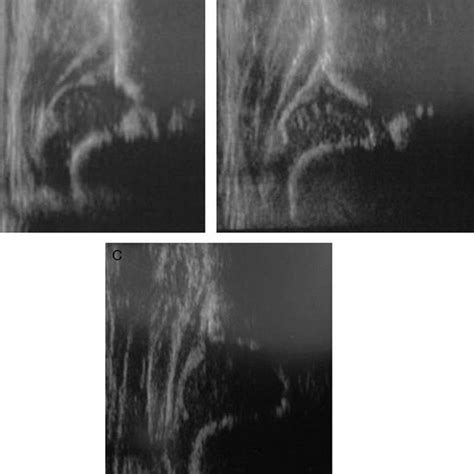 Graf Classification System Of Developmental Dysplasia Of The Hip Based