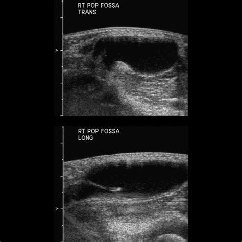 Pediatric Popliteal Cyst Pediatric Radiology Reference Article