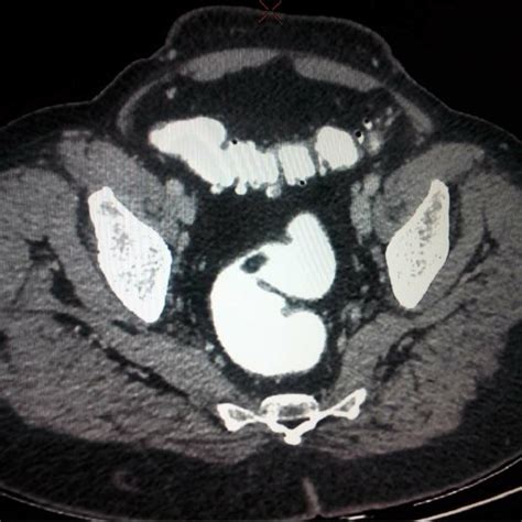 Colonoscopy Showed Diverticulosis Present In Entire Colon Starting From
