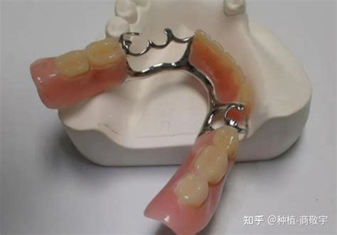 拔牙后，种牙还是镶牙？看完这篇你就知道该如何选择！ 知乎