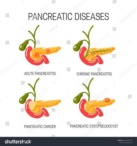 Diseases Pancreas Concept Medical Vector Illustration Stock Vector