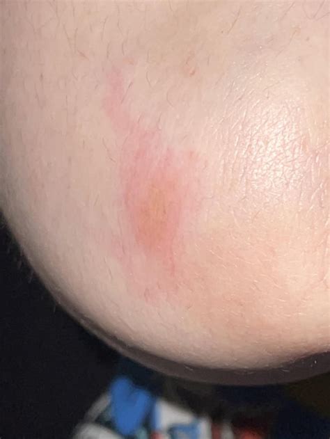 What Bit Me R Bugbite