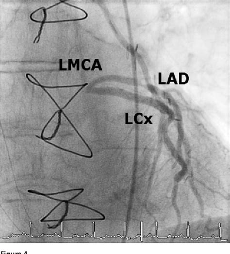 Figure 1 From Iatrogenic Left Main Stem Stenosis After Surgical Aortic
