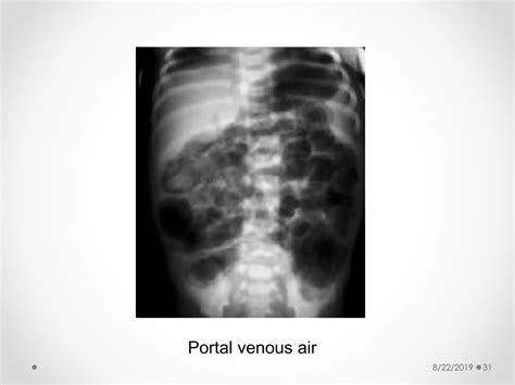 Necrotising Enterocolitisnec Pdf