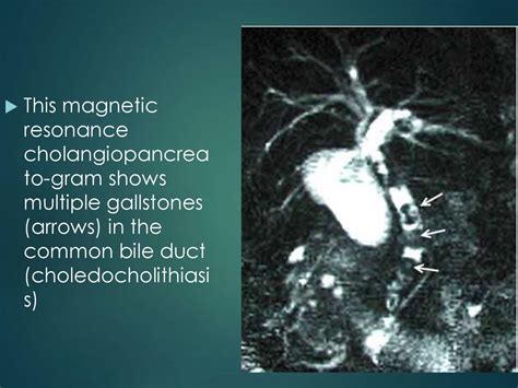 Chronic Cholecystitis Online Presentation