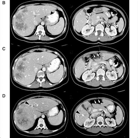 Advanced Bilateral Colorectal Liver Metastases At Diagnosis A After Download Scientific