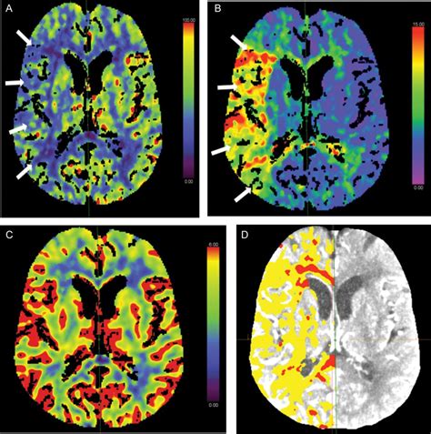 Computed Tomography Perfusion Brain Parametric Maps Clockwise From