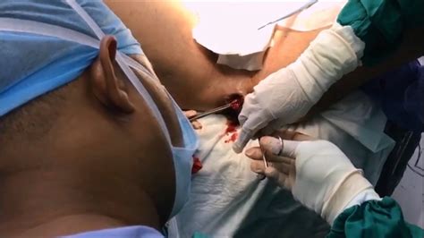 Hemorroidectomia Youtube