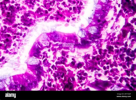 Villous Colon Adenocarcinoma Light Micrograph Photo Under Microscope