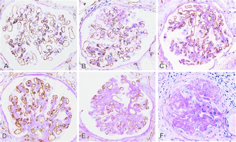 Several Glomerular Capillary Alterations In Cases Of Idiopathic Download Scientific Diagram