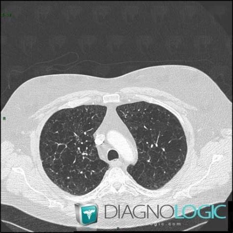 Cas radiologie Histiocytose à cellules de Langerhans IRM Scanner Diagnologic