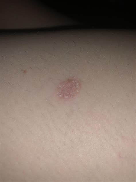 Is This Ringworm What Is It R Medical