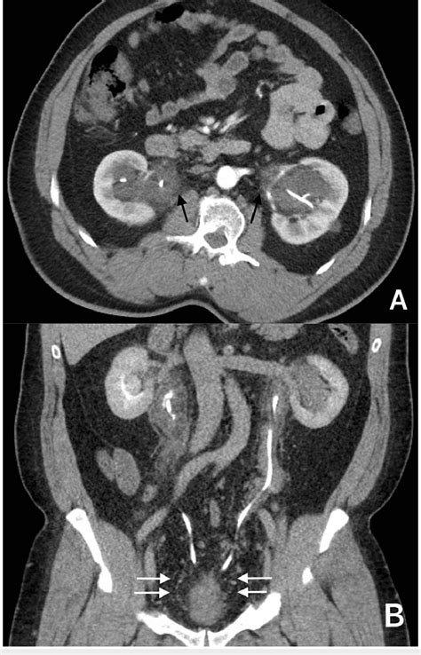 Pre Operative CT Axial And Coronal View A Axial View B Coronal Download Scientific