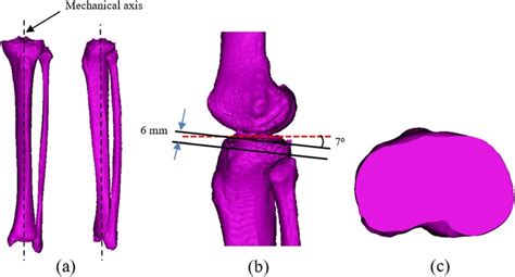 D Model Of The Tibia Bone A Tibial Mechanical Axis B Position Of The Download Scientific