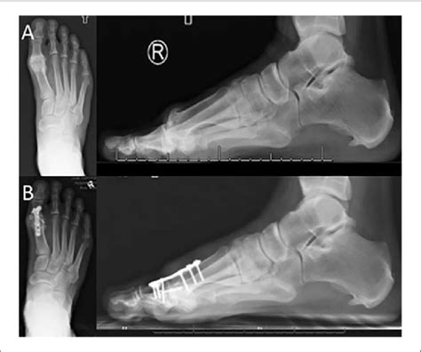 First Metatarsophalangeal Joint Arthrodesis A Significant Sclerosis