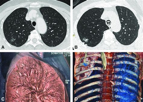 The Precision Of Template Guided Localization Evaluated By