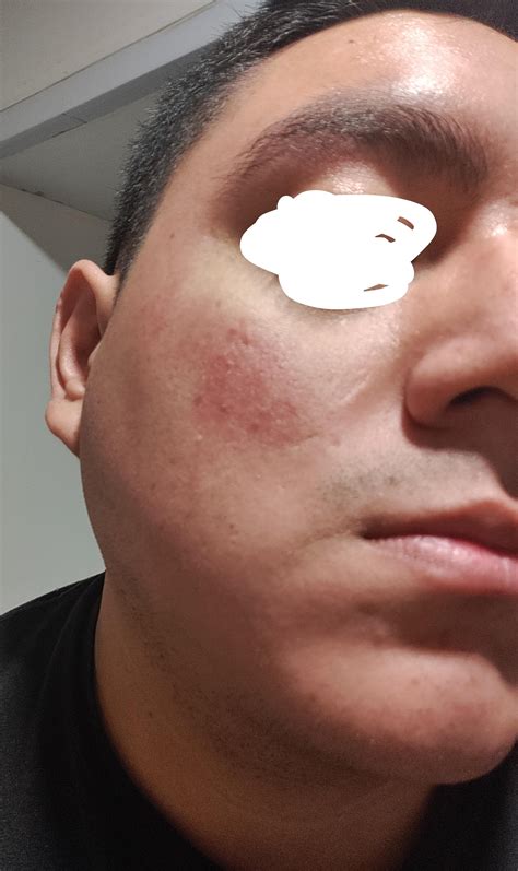 Red Skin And Pimple A Cycle R Skincareaddicts