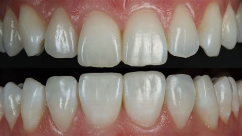 Pros And Cons Of Composite Bonding Smile Stories