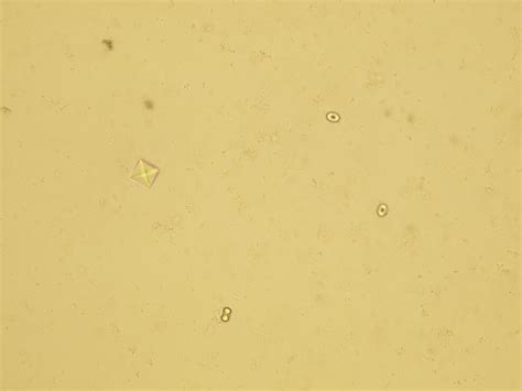 Calcium Oxalate Monohydrate Crystals