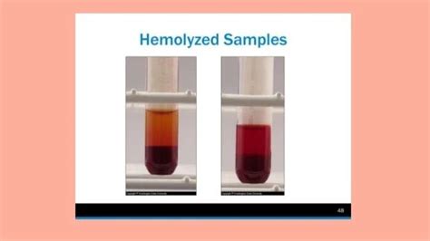 Lokesh Upadhyay On Linkedin The Hemolyzed Sample To Analyse Or