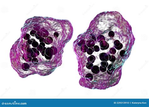 Giant Multinucleated Cells Stock Illustration Illustration Of Lymph