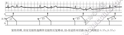 附图 窦性停搏房室交接性逸搏伴交接性反复搏动结 房逆传双径路心电图 心电图学 天山医学院