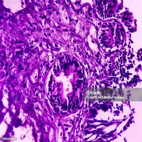 Cáncer De Próstata Adenocarcinoma Neoplasia Maligna Células Epiteliales