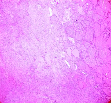 Hematoxylin Eosin Staining Showed Spindle Shaped Cells With