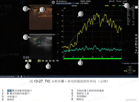 医学超声模式简介 Csdn博客