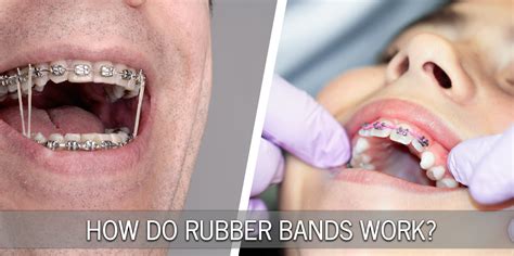 What Do The Rubber Bands Do In Braces At Marianne Cochrane Blog